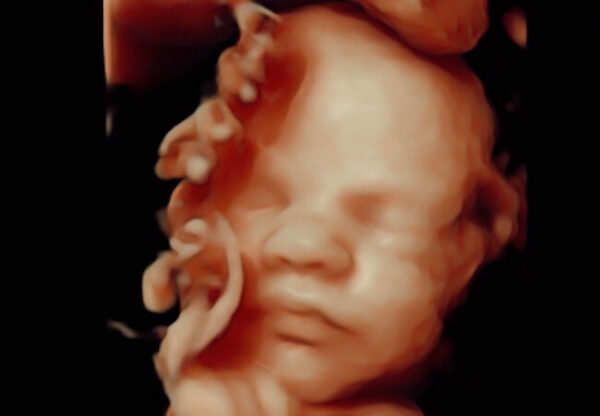Uitgebreide 3D/4D echo - Goud echo en prenatale screening